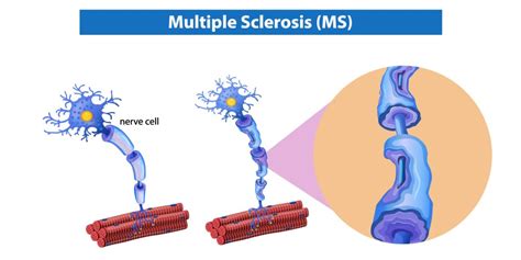 Multiple Sclerosis Causes Symptoms And Diagnosis