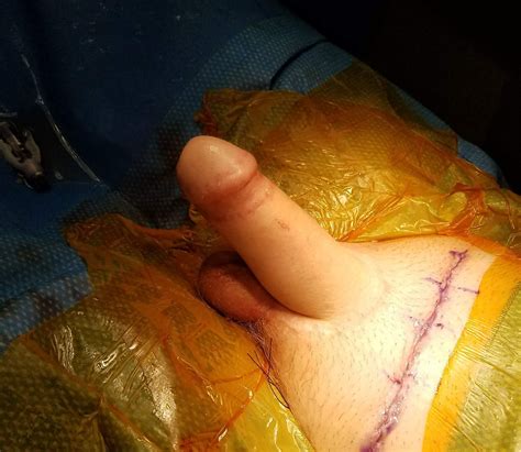 Photos Glansplasty Mang Chen Gurecon