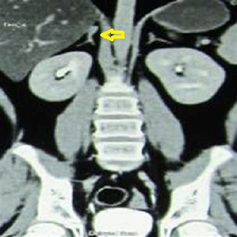 Macroscopic Pathological Image Showing Macronodular Adrenal Hyperplasia Download Scientific
