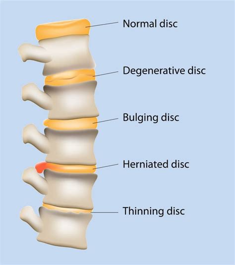 What Causes Sciatica To Flare Up Learn The Causes And Symptoms