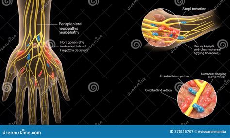 Peripheral Neuropathy Medical Poster Vector Illustration