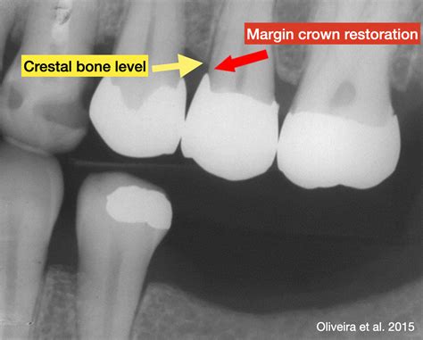 What Is Biologic Width