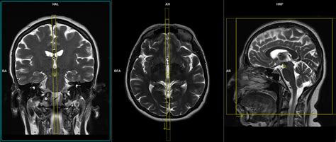 Cerebrospinal Fluid Flow Mri Csf Flow Mri Protocol And Planning