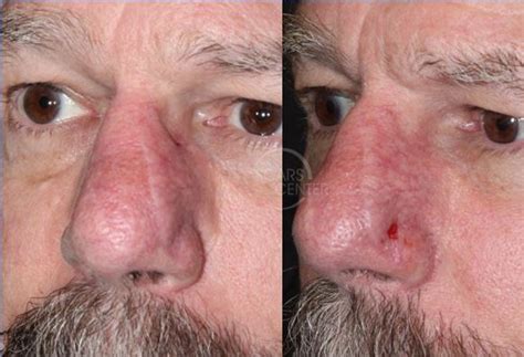 Squamous Cell Carcinoma Nose
