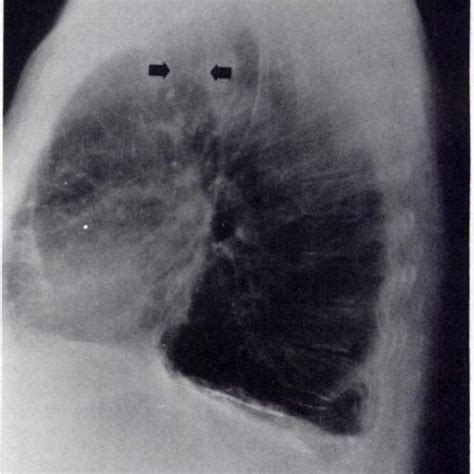 Ct Scan Showing A Hyperlucent And Hyperexpanded Left Upper Lobe With An