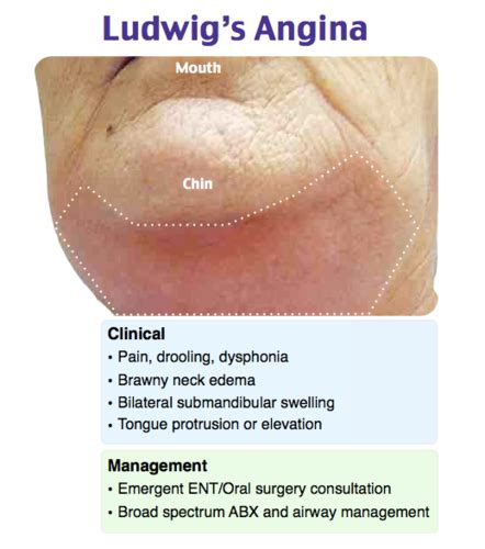 Ludwigs Angina Flashcards Quizlet