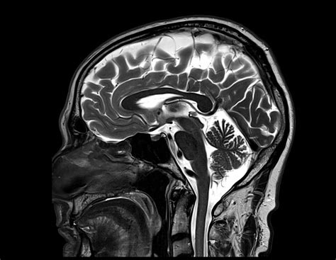 T2 Mri T2 Weighted Mri Sequence Physics And Image Appearance