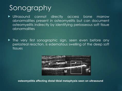 Chronic Osteomyelitis Both Acute And Chronic Pptx