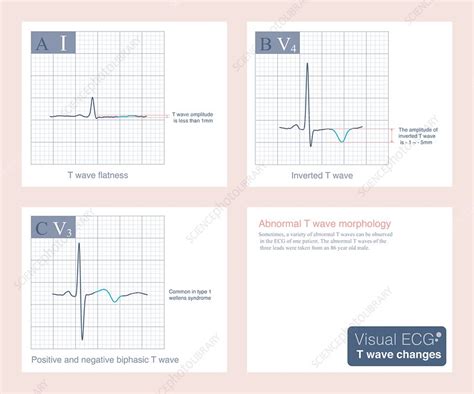 T Wave Ecg The Prognostic Significance Of Q Waves And T Wave