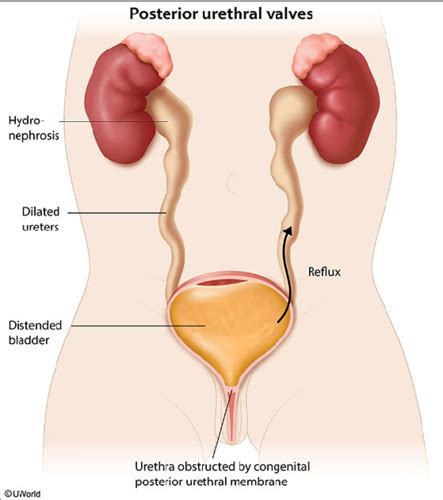 Urinary Tract Obstructions Quiz Flashcards Quizlet