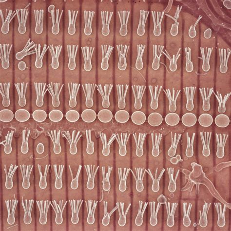 Sensorineural Deafness Breaking Through The Silence What You Need To