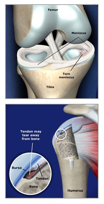 Prolotherapy Injections Artofit