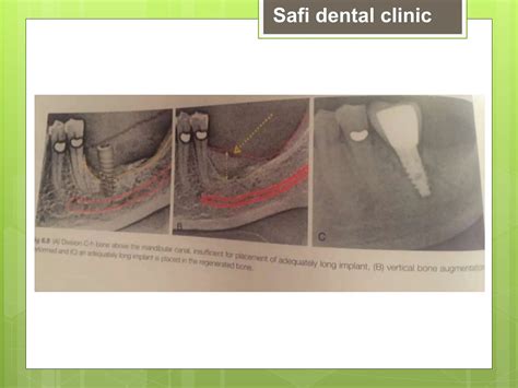 5 Bone Density For Dental Implants 5 Pptx