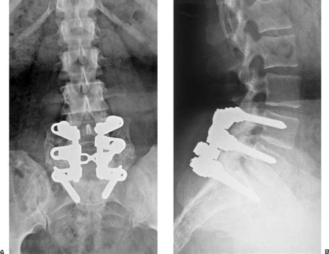 Lumbar Corpectomy Neupsy Key