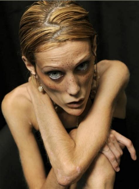 Anorexia