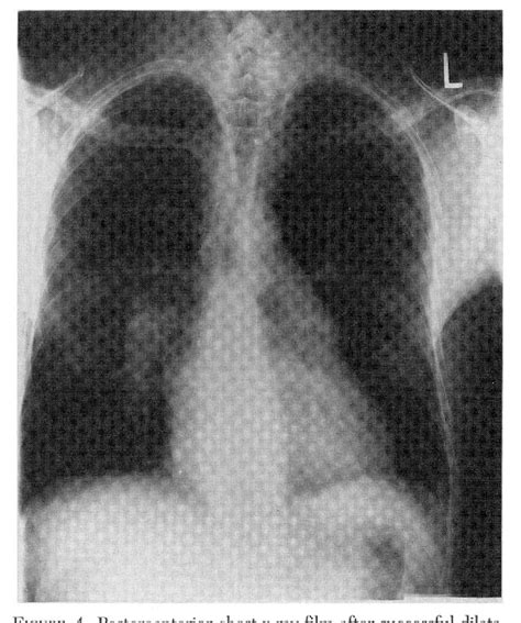 Figure 4 From A Posterior Mediastinal Mass Diagnosed By Echocardiogram Semantic Scholar