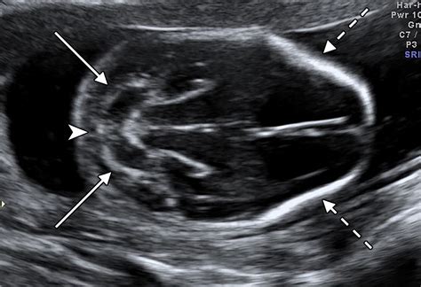 Abnormalities Of The Fetal Central Nervous System Prenatal Us