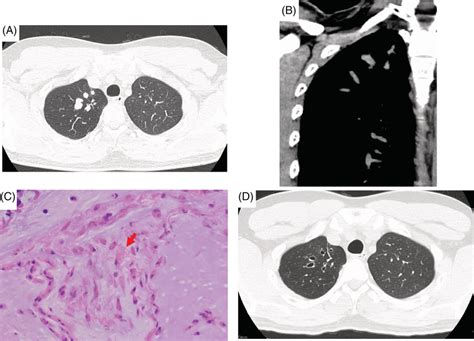 A B Chest Computed Tomography Ct At The First Visit Download