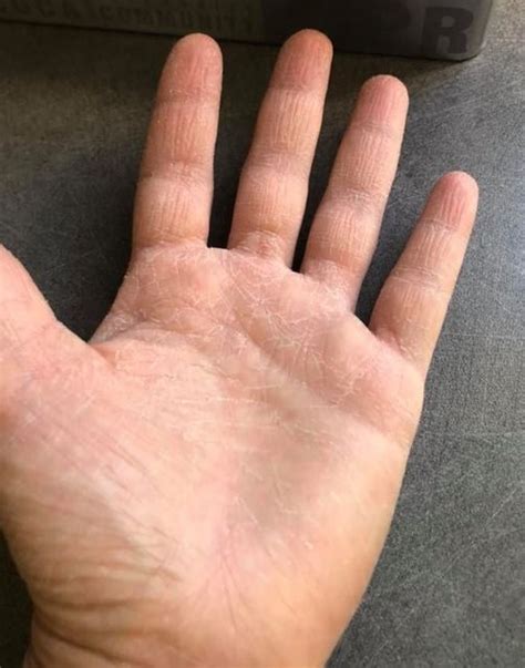 Iontophoresis Side Effects 269 Free Shipping Iontophoresis Machine