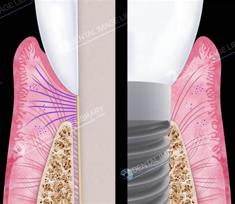 Representation Of Tooth And Implant Attachment To Surrounding Tissue