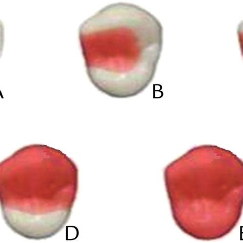 A E Five Options Regarding The Amount Of Coronal Tooth Structure
