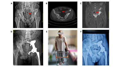 A 53 Year Old Patient With Chondrosarcoma Of The Pelvis Underwent