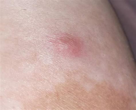 Pickel An Der Brustwarze Ursachen Behandlungen Und Mehr Kadth