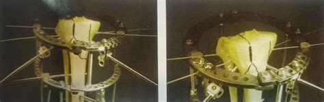 一文了解 胫骨近端骨折：环形外固定架固定架克氏针膝关节胫骨骨折 健康界