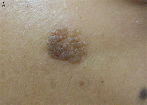 Cutaneous Lymphangioma Circumscriptum Consultant360