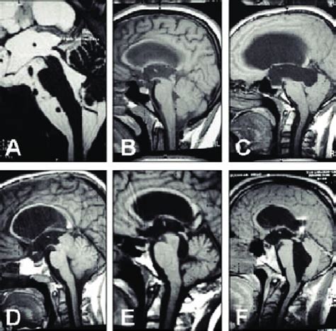 Possible Etiologies Of Obstructive Hydrocephalus Legend A