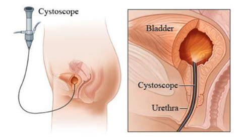 Cystoscopy With Bladder Biopsy New Tampa Urology