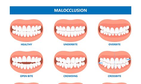 How Cosmetic Dentistry Can Improve Your Bite Alignment Advanced