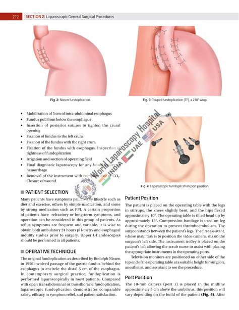Laparoscopic Fundoplication At World Laparoscopy Hospital Pdf