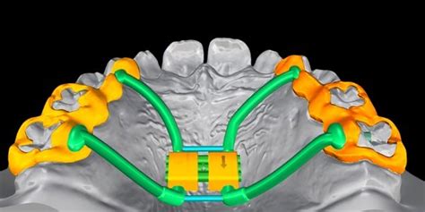 The Occlusogram Software For The Implementation Of Orthodontic