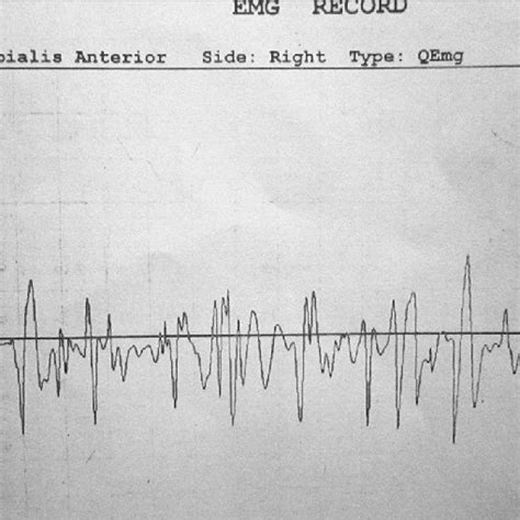 Normal Pattern Of Electromyogram Study In Tibialis Anterior Muscle