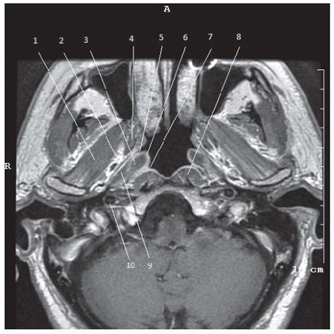 Radiologic Evaluation Of The Head And Neck Cancer Patient Ento Key