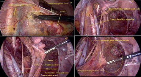 Laparoscopic Lateral Pelvic Lymph Node Dissection For Advanced Lower