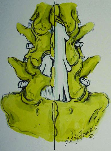 Left Sided Partial Laminectomy L4 L5 Laminotomy And Right Sided