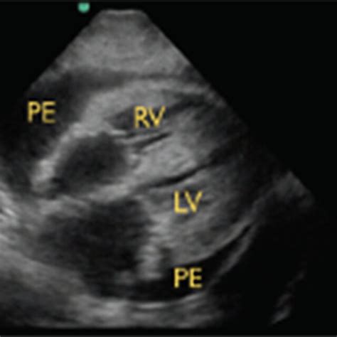 Subcutaneous Edema Demonstrated Via Abdominal Skin Pocus In Long Axis