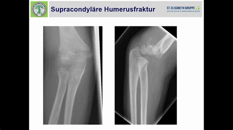 14 16 Kindliche Ellenbogenverletzungen Was Gibt Es Zu Beachten