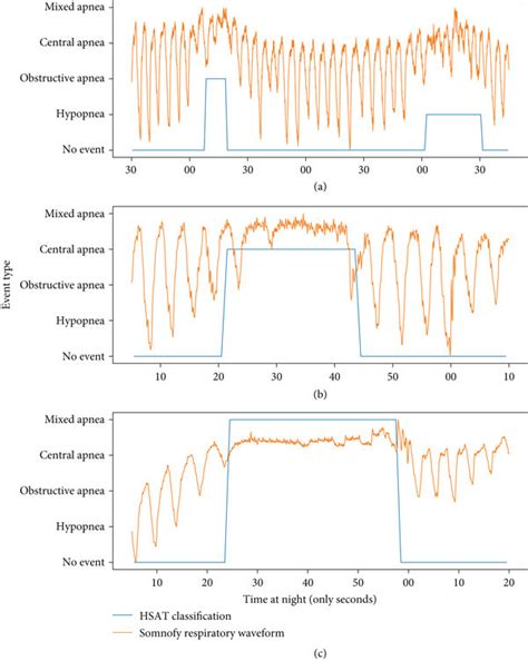 Illustration Of The Respiratory Waveform From Somnofy During Hypopnea
