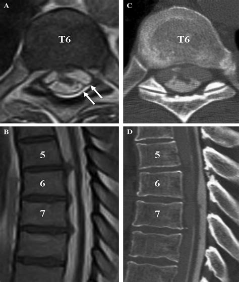 Ventral “spinal Epidural Meningeal Cysts”—not Epidural And N Neurosurgery
