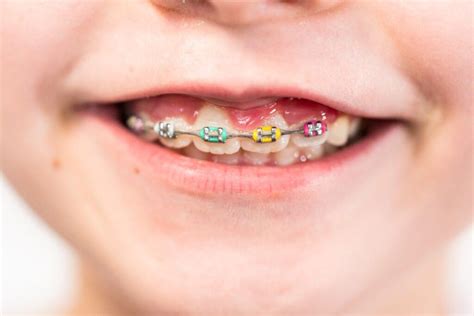 How Much Does Braces Cost In Australia Ortho Co