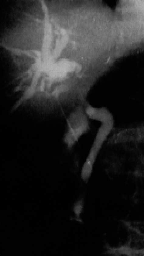 Ptc Examination Shows Long Stricture At The Proximal Cbd 5 Stricture Of Download Scientific