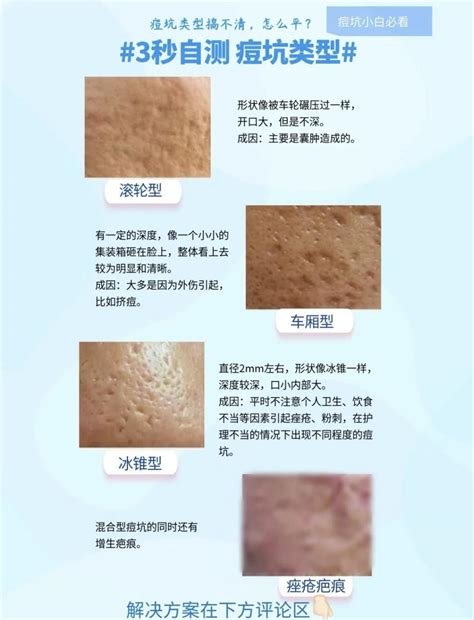 痘坑类型与治疗方法