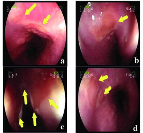 A Two Different Inlet Patch Zone 14 Cm Distal From The Incisors B Download Scientific