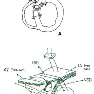 Modified Infarct Exclusion Technique With Double Patch And Application