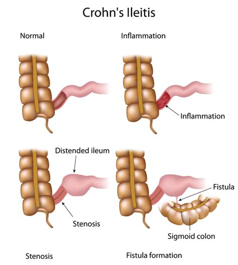 Crohns Disease Medlineplus Genetics