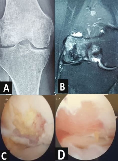 Treatment Options For Secondary Osteonecrosis Of The Knee Published