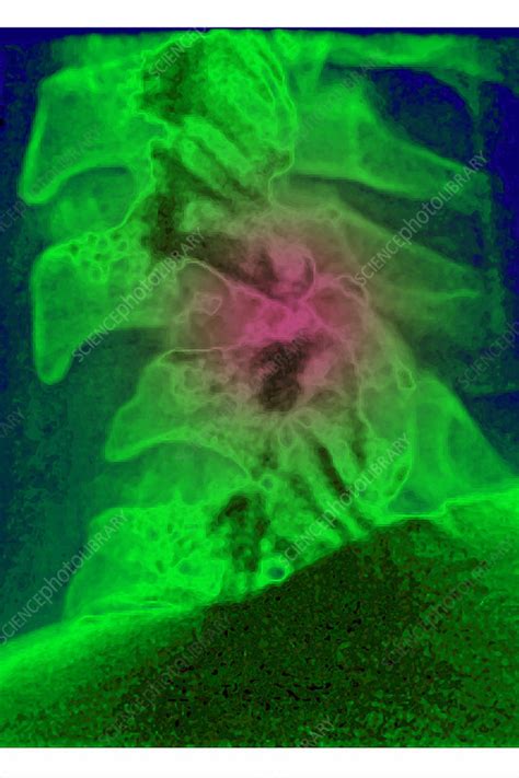 Cervical Vertebrae Dislocation X Ray Stock Image C0306789